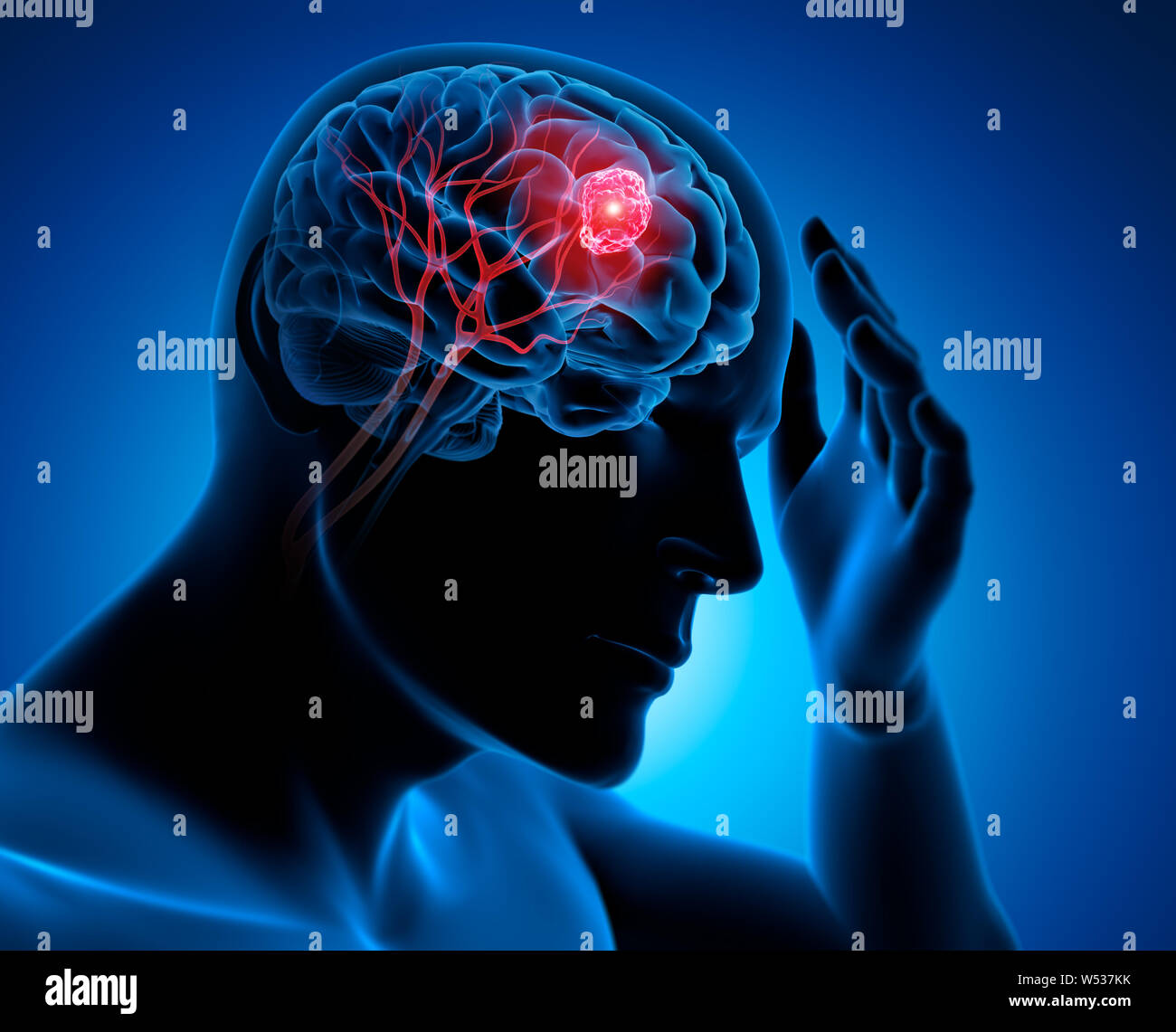Brain tumor anatomy hi-res stock photography and images - Alamy
