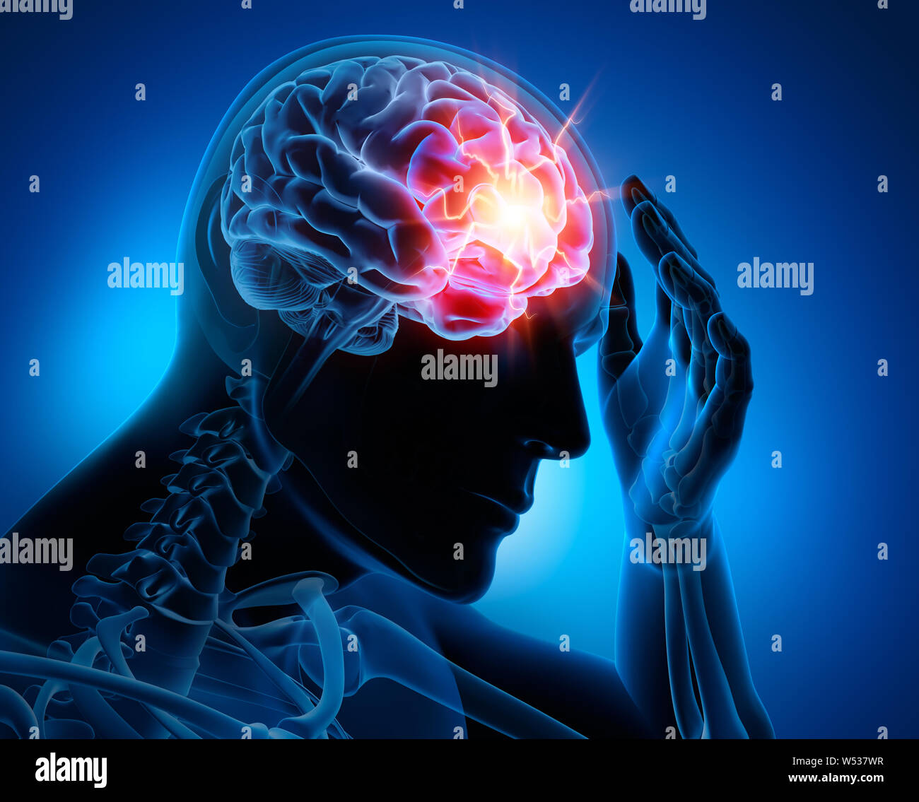 Brain attack hi-res stock photography and images - Alamy