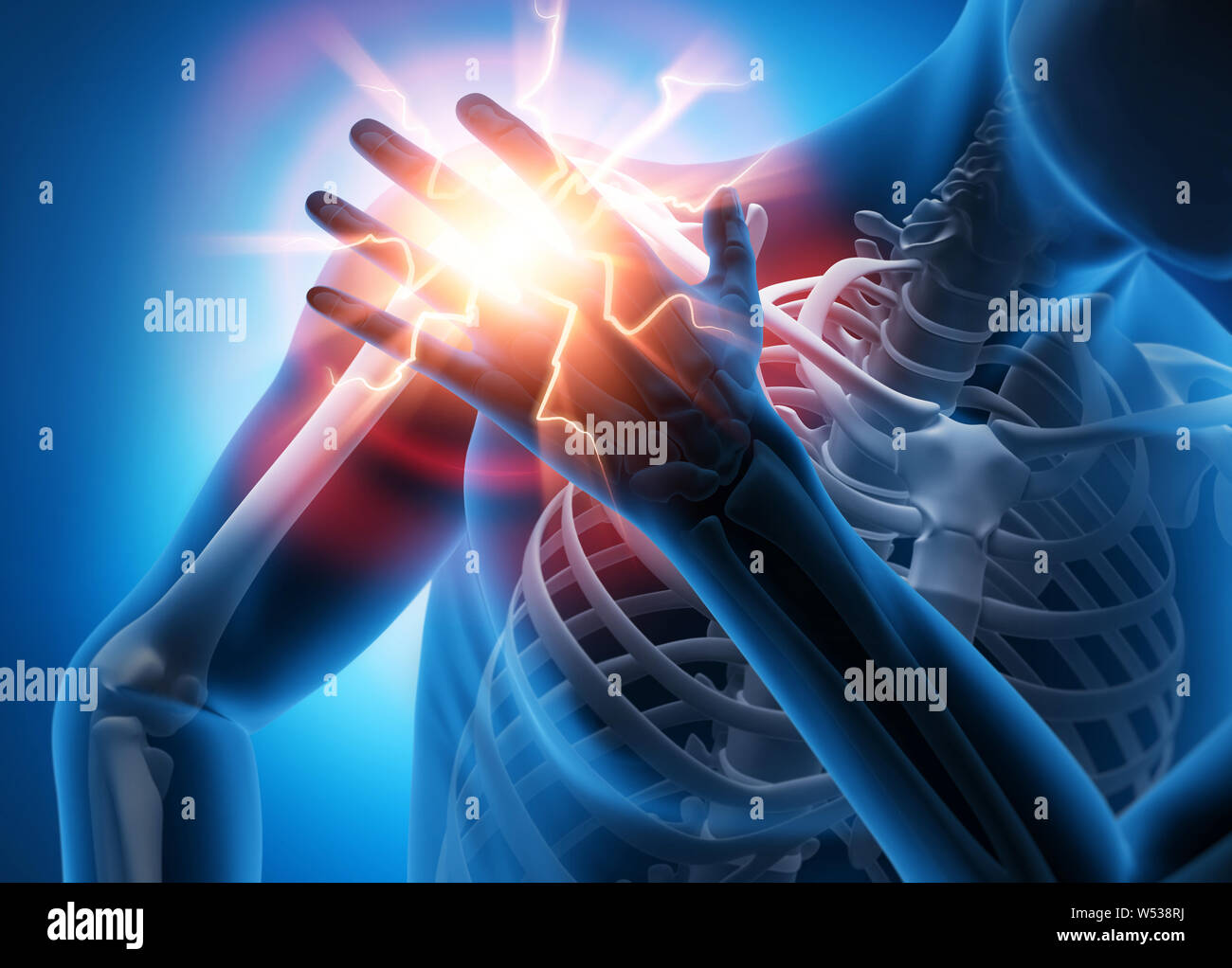 Shoulder Pain - 3D Medical Illustration Stock Photo - Alamy