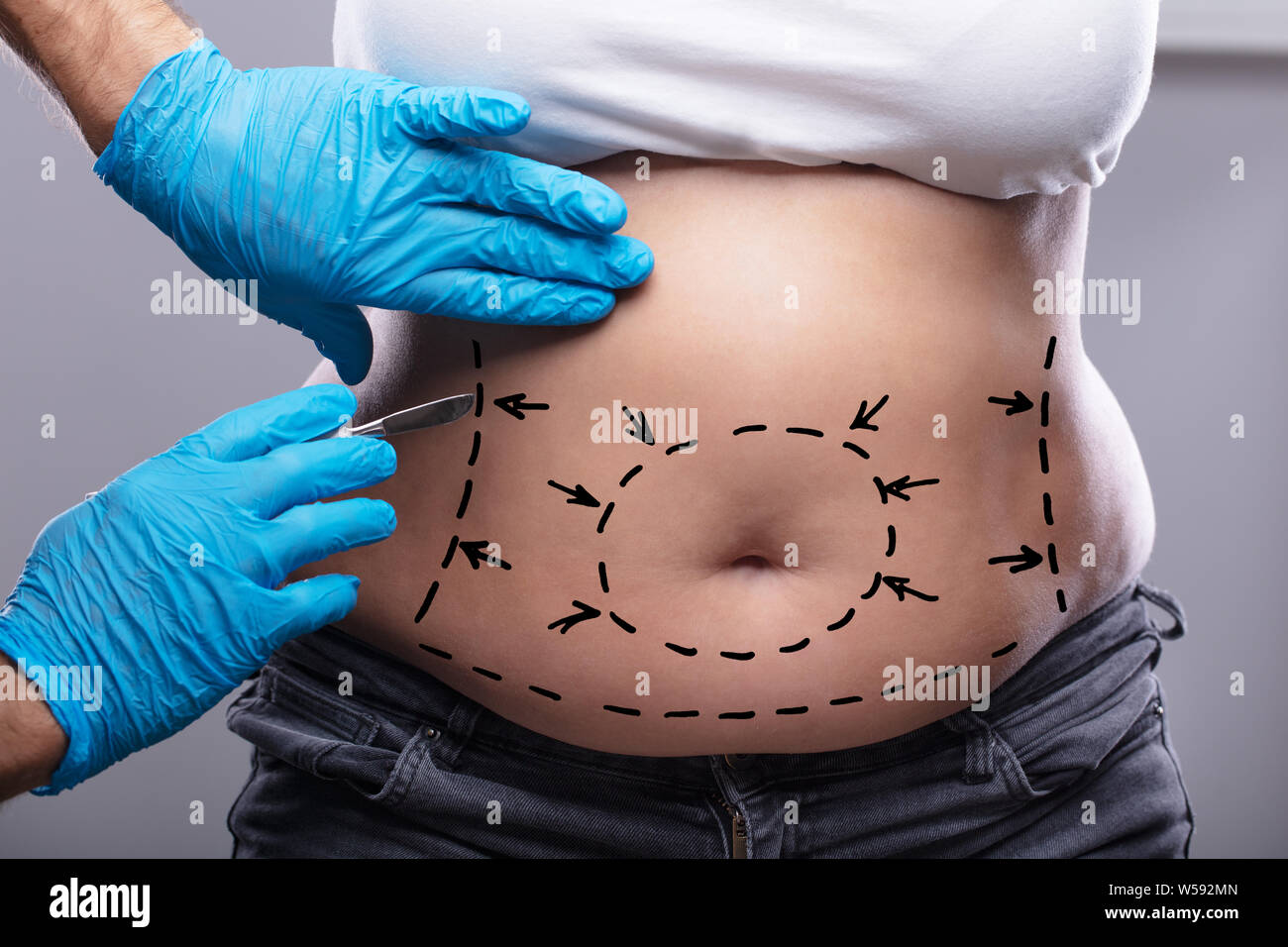 Woman marked plastic surgery hi-res stock photography and images - Alamy