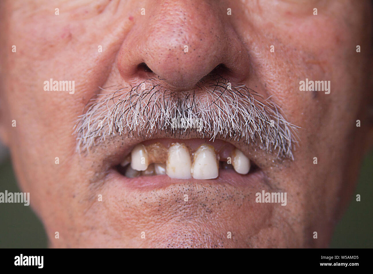Unhealthy teeth. Bad dental care. Senior man teeth Stock Photo - Alamy