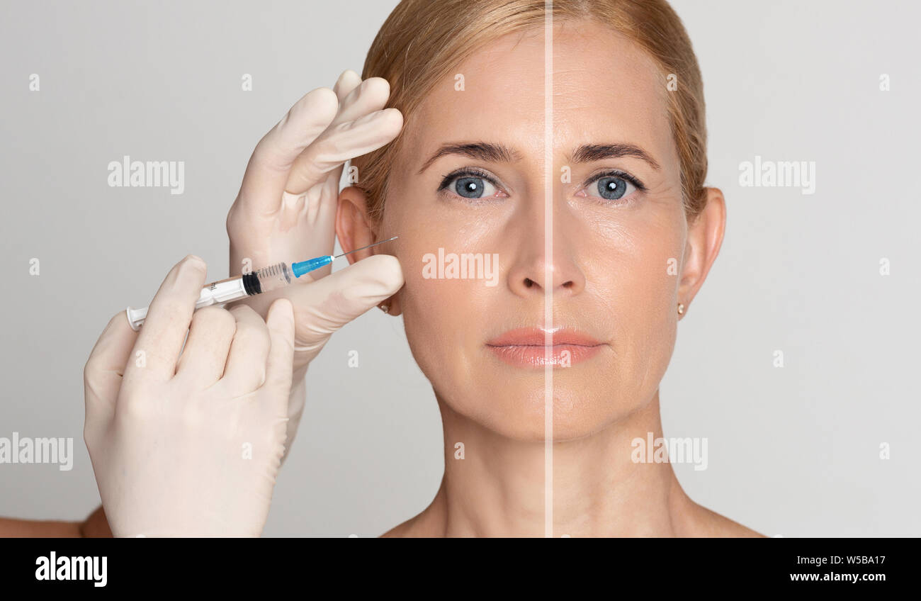 Injection for aged woman with syringe for both parts of face Stock ...