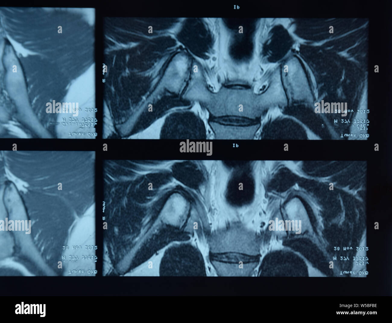 Mri sacrum hi-res stock photography and images - Alamy