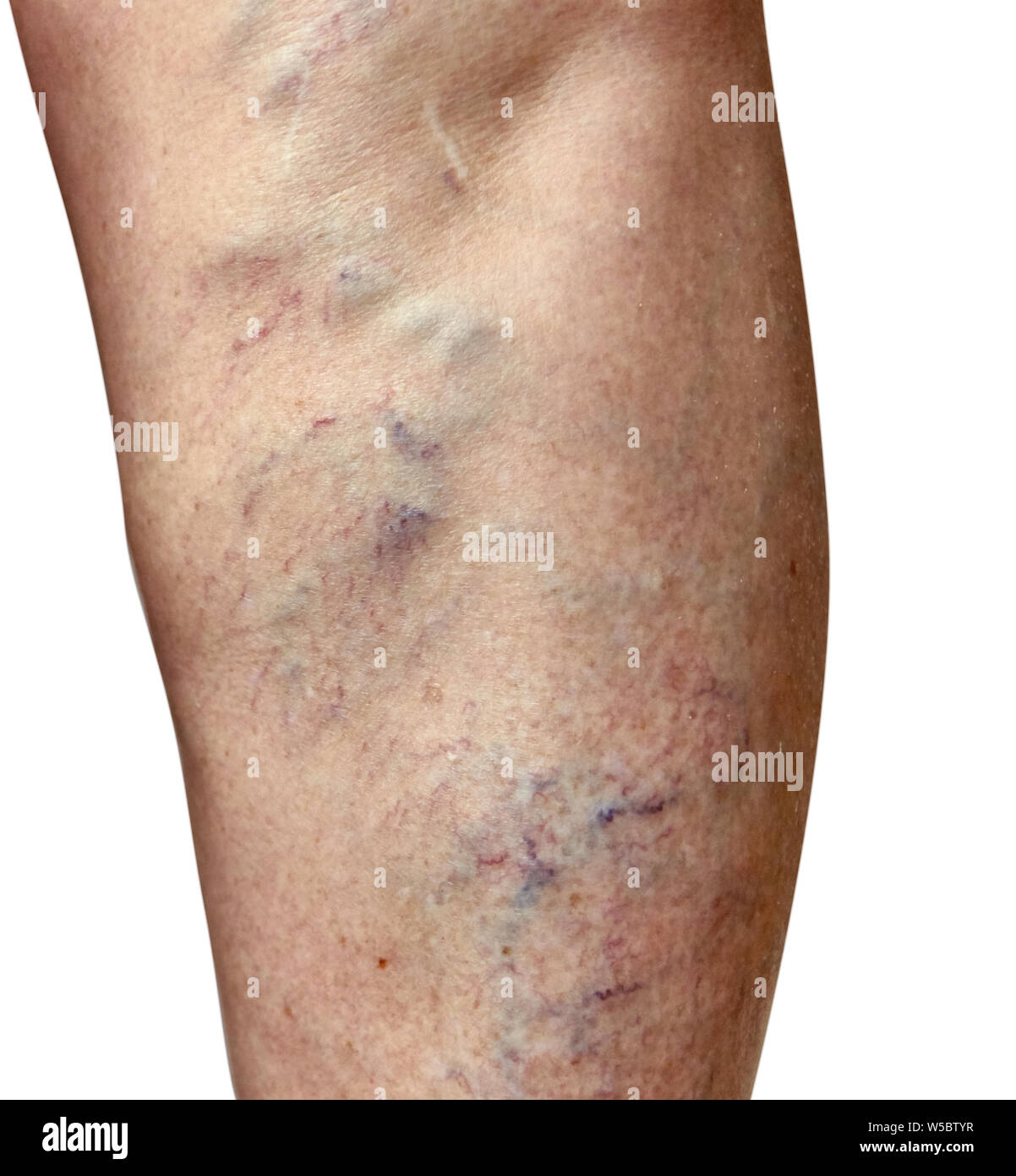 Varicose veins on a female legs. Phlebology. CLose up isolated leg ...