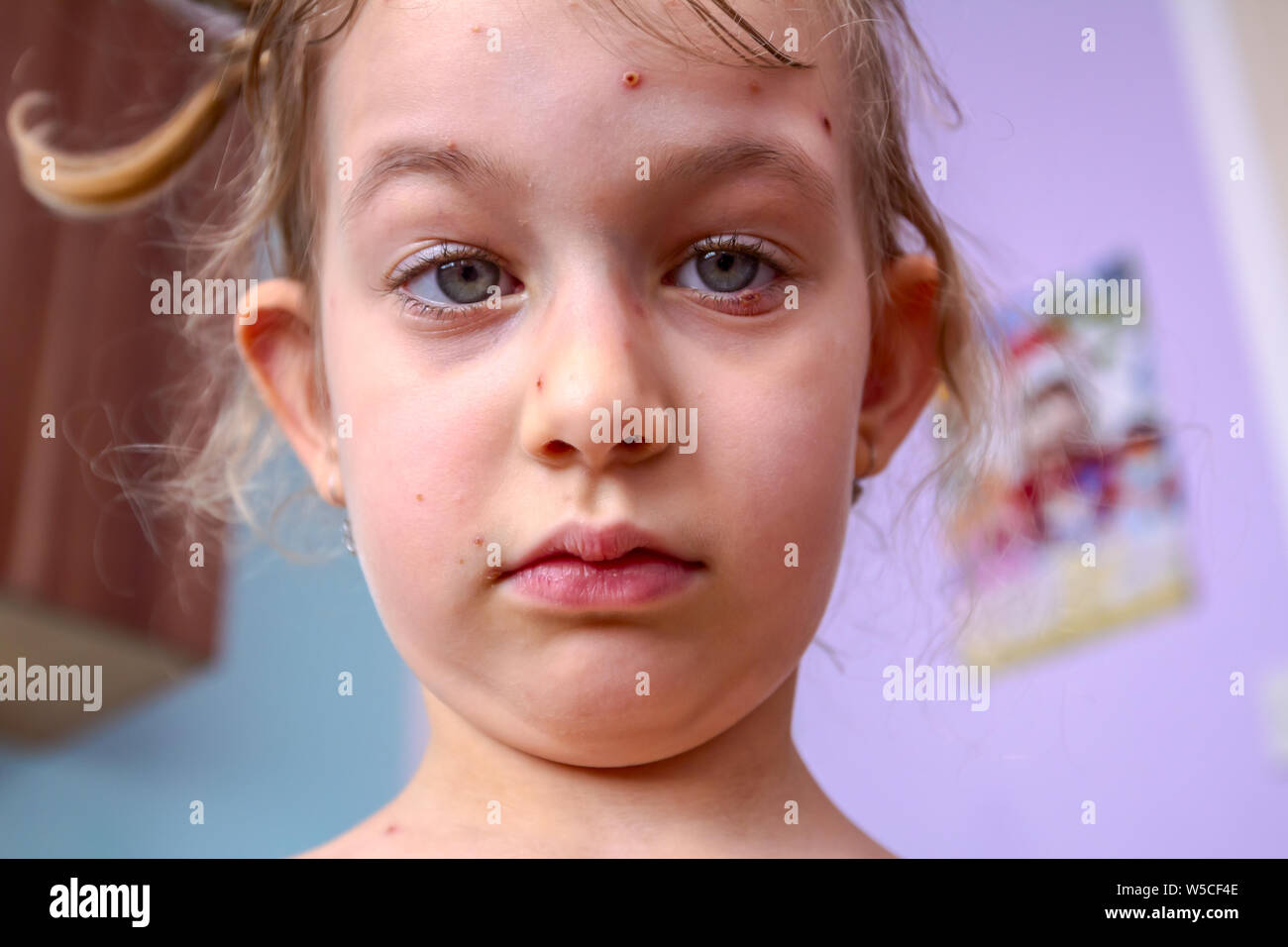 Little girl chicken pox hi-res stock photography and images - Alamy