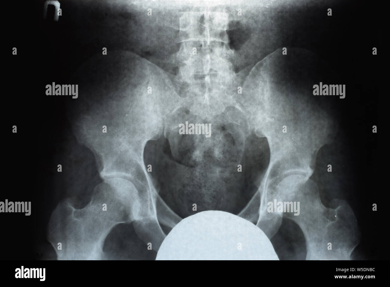 Sacrum Anatomy Xray