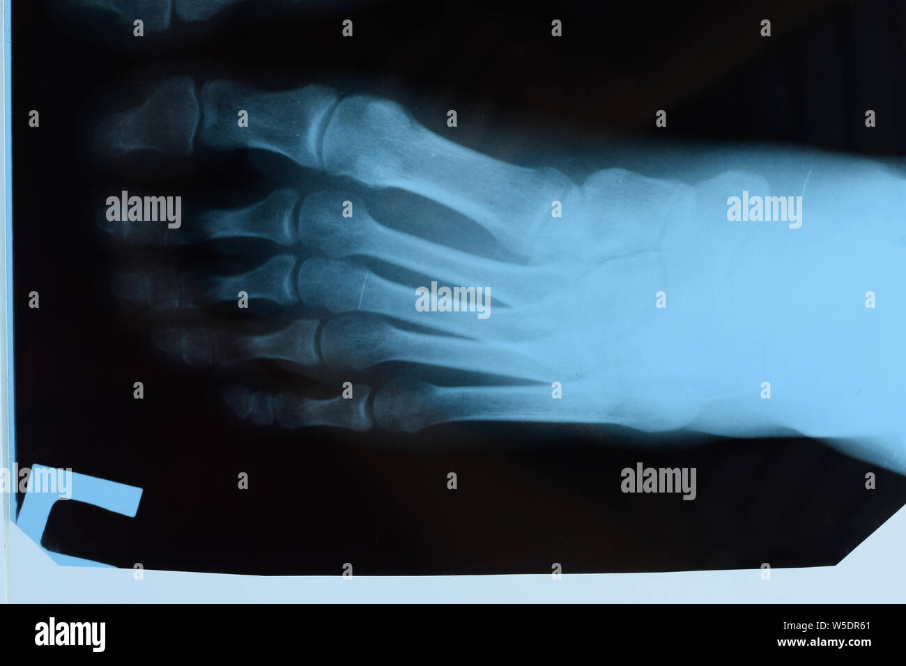 X-ray of toes. Foot on X-ray. bone research Stock Photo - Alamy