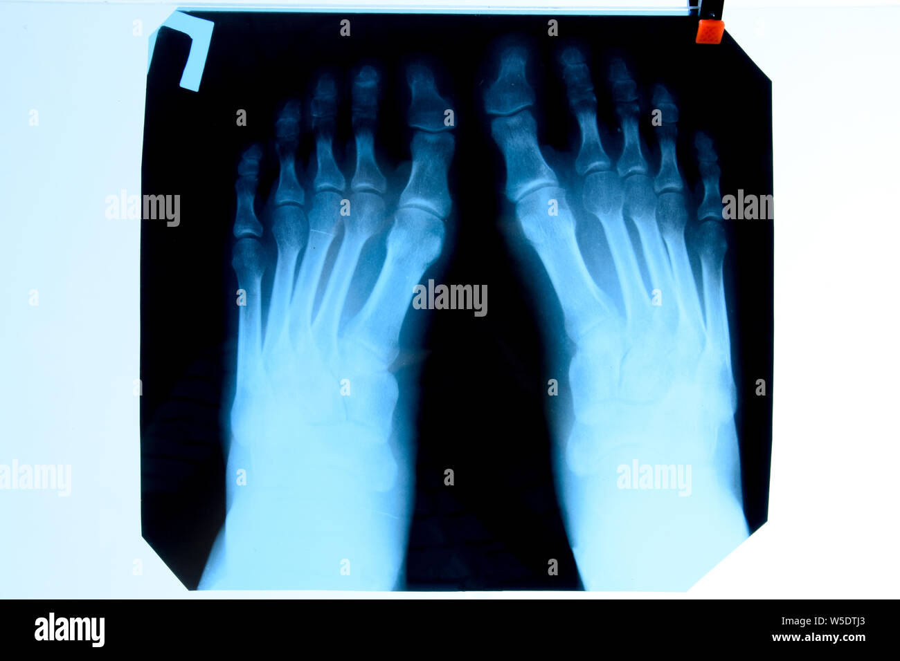 X-ray of toes. Foot on X-ray. bone research Stock Photo - Alamy
