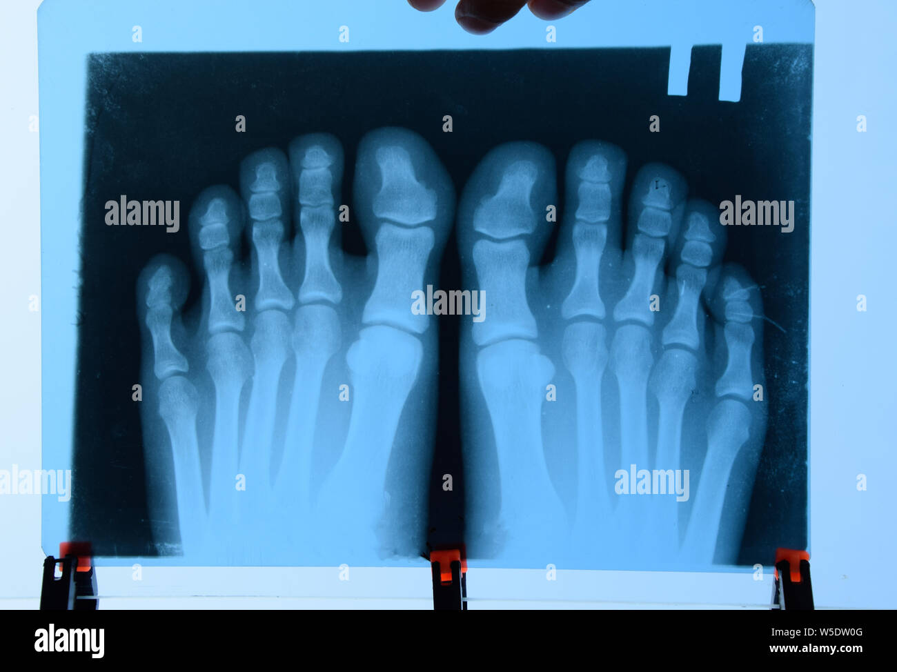 X-ray of toes. Foot on X-ray. bone research Stock Photo - Alamy