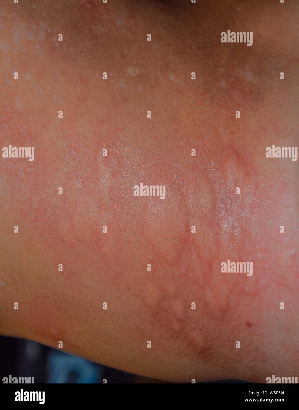 Allergy skin back and sides. Allergic reactions on the skin in the form ...