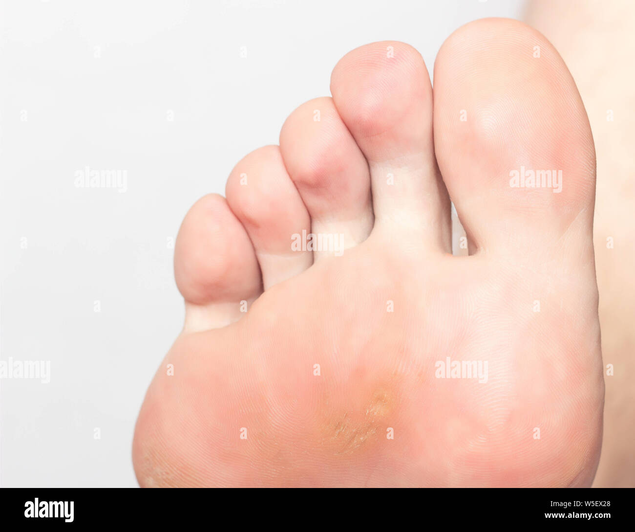 Dry mazol and natoptysh with an internal core on the sole and leg of a person, close-up ...