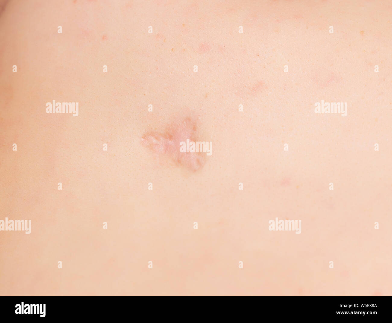 Cicatrix scar hi-res stock photography and images - Alamy