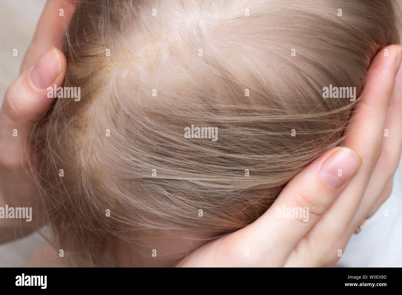 Fungal skin disease seborrheic dermatitis in a child's head, close-up ...