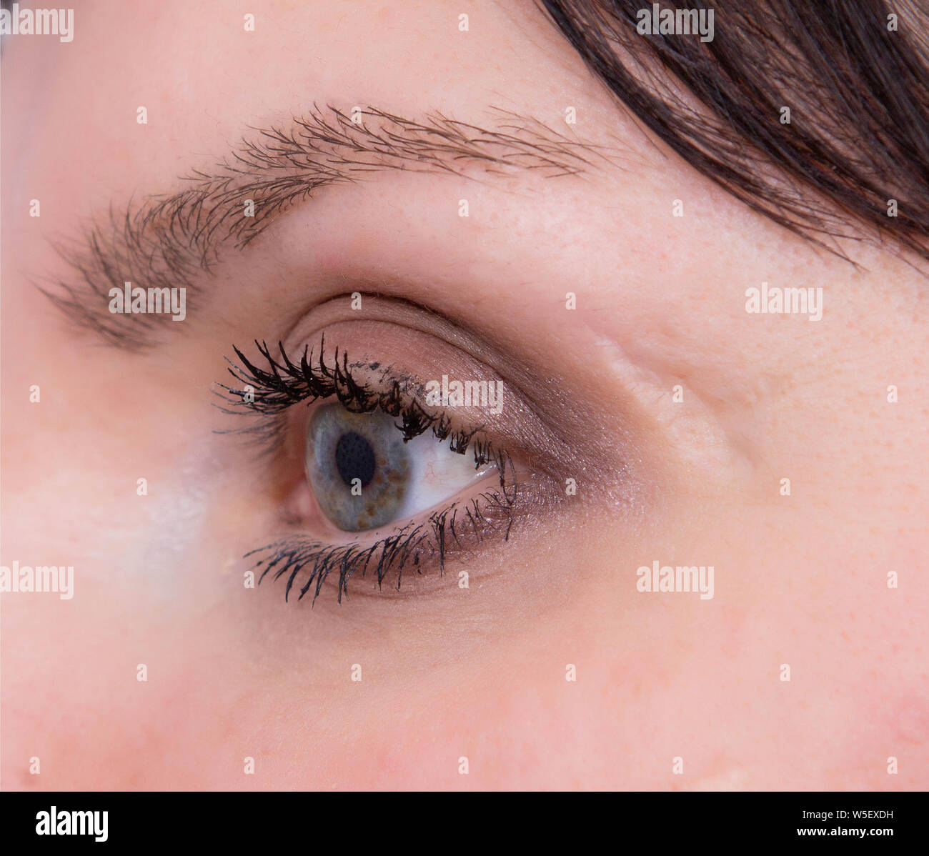 deep scar on the skin of the girl on the face near the eye, close-up ...