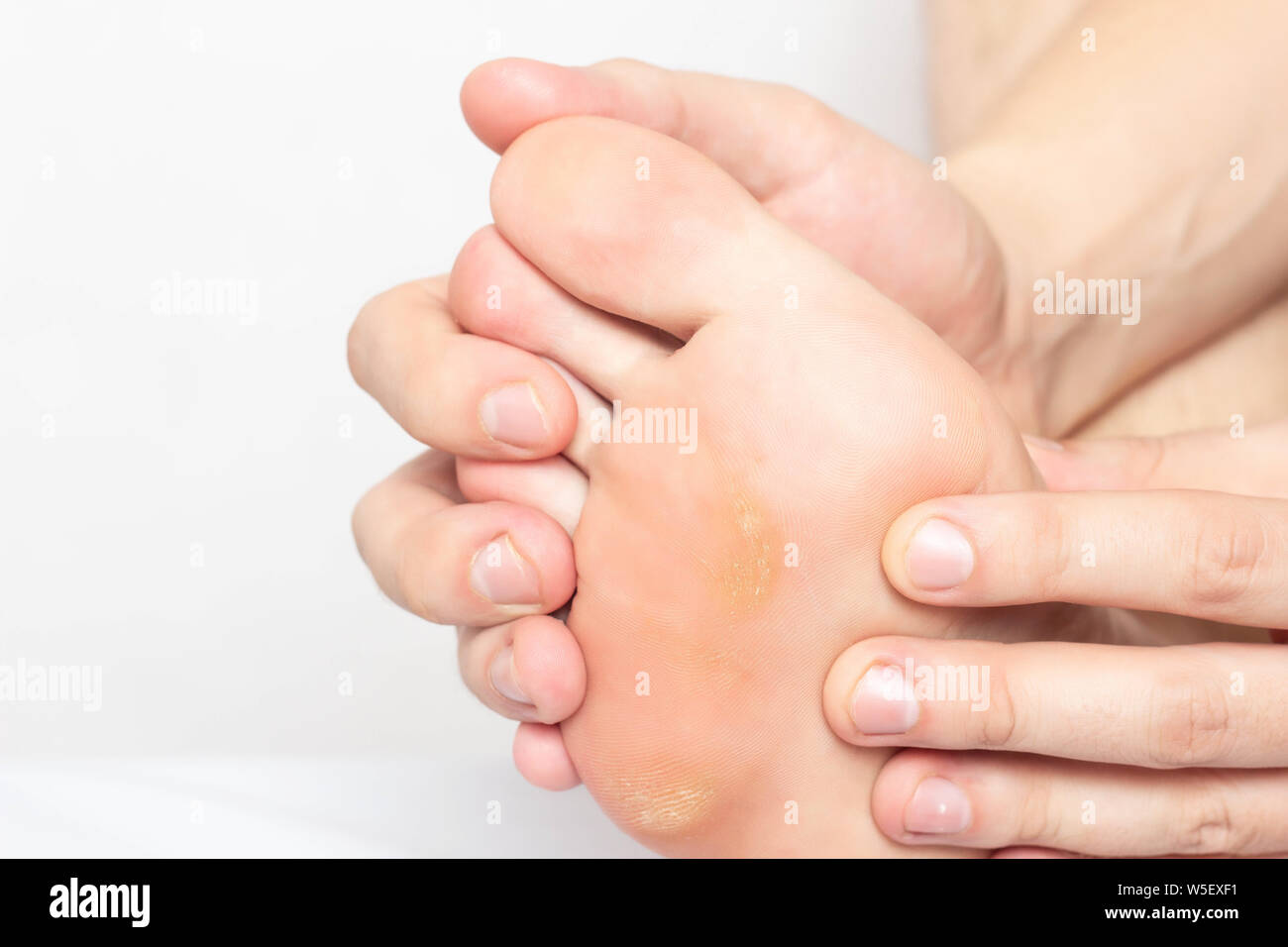 Man shows problem skin on the foot and sole of the foot dry and callous ...
