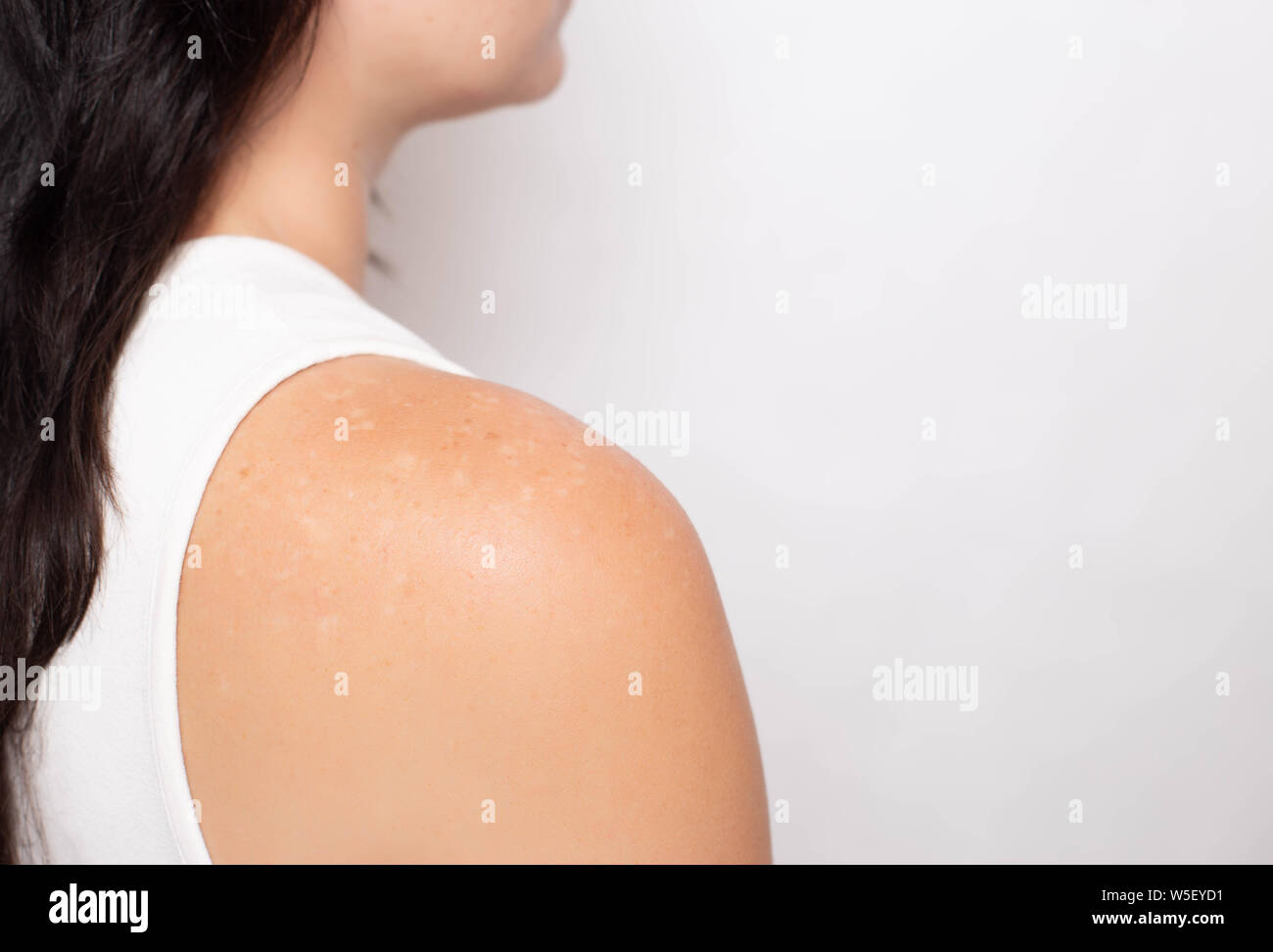 Pigmentation Spots Stock Photos & Pigmentation Spots Stock Images - Alamy