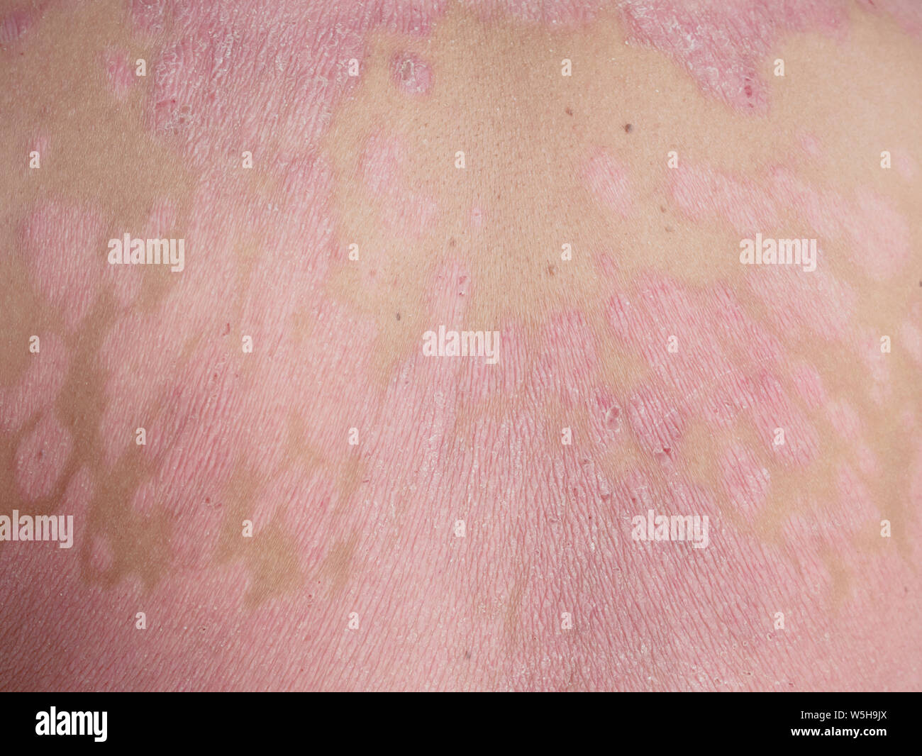 Close up flakes on the back. Diseases caused by abnormalities of the ...