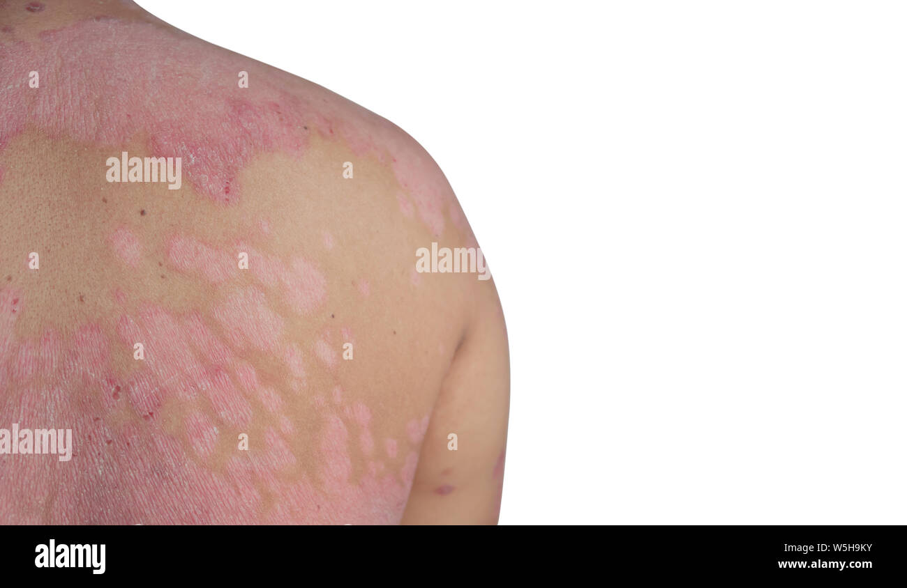 Scaly rash hi-res stock photography and images - Alamy