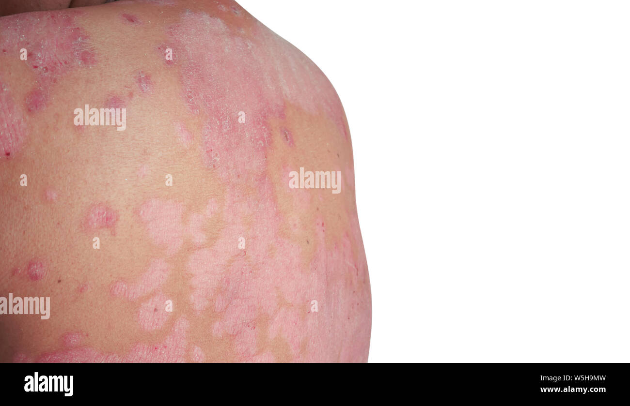 Close up flakes on the back. Diseases caused by abnormalities of the ...