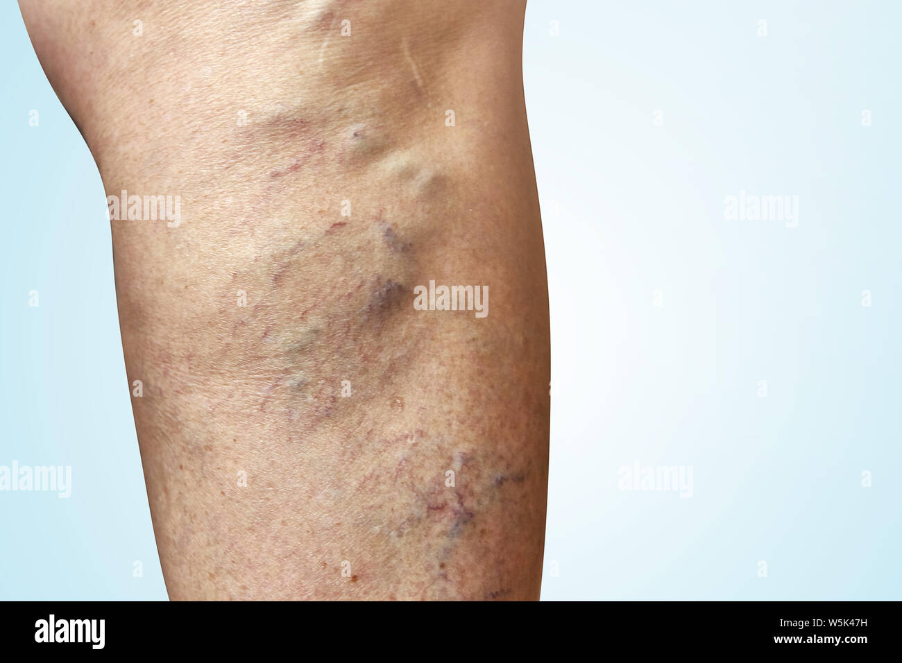 Varicose veins on a female legs. Phlebology. CLose up isolated leg ...