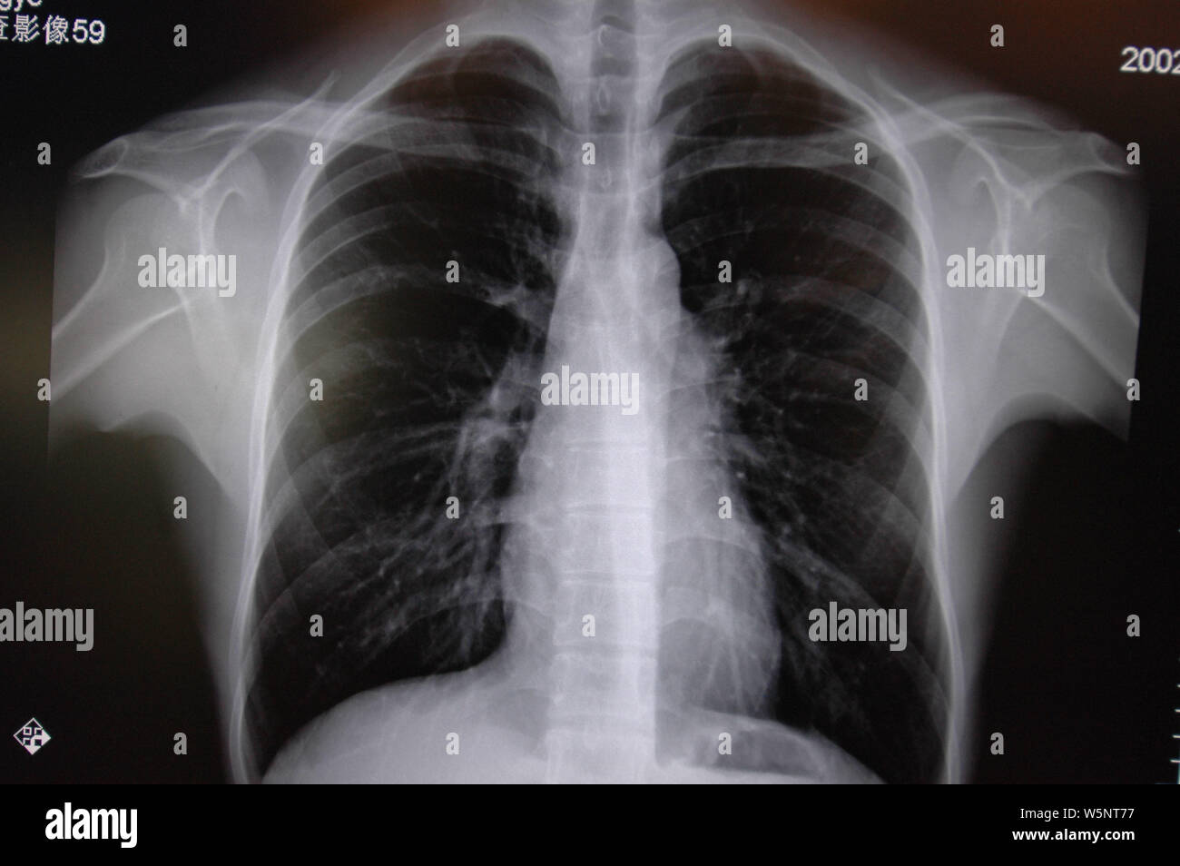 Sars china 2004 hi-res stock photography and images - Alamy