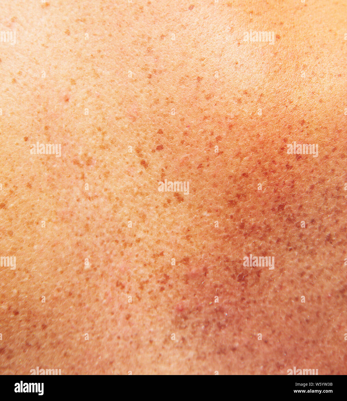 Freckled Back Skin Stock Photo - Alamy