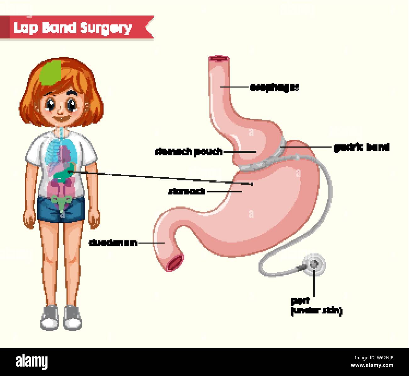 Scientific medical illustration of lap band process illustration Stock ...