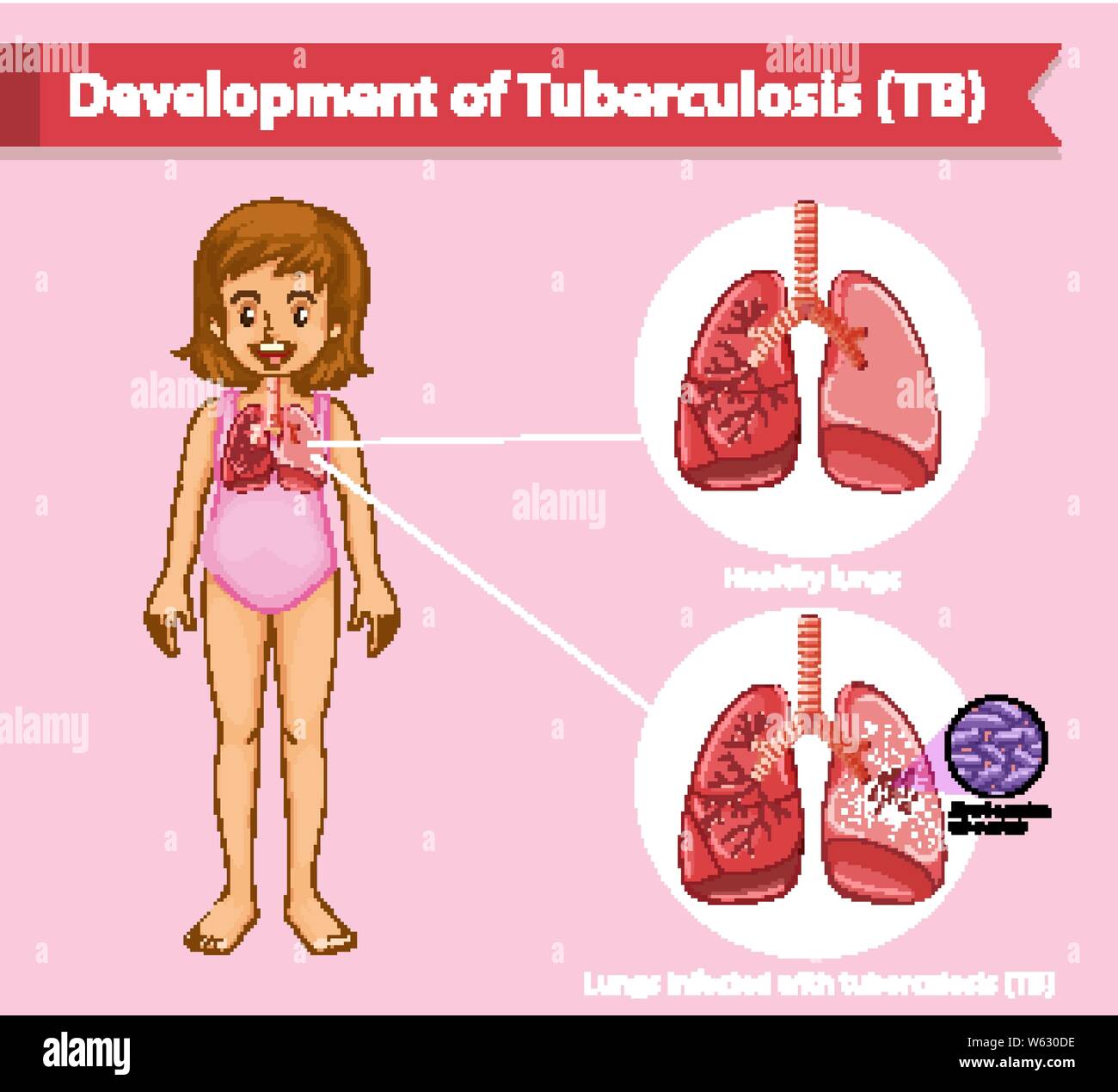 Scientific medical illustration of tuberculosis TB illustration Stock ...