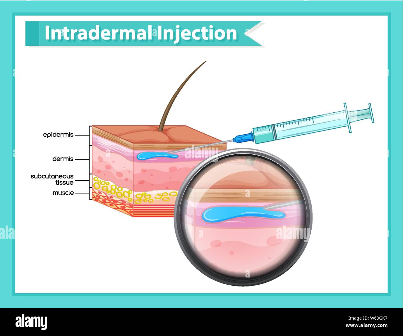 Scientific medical illustration of injection - Intradermal illustration ...
