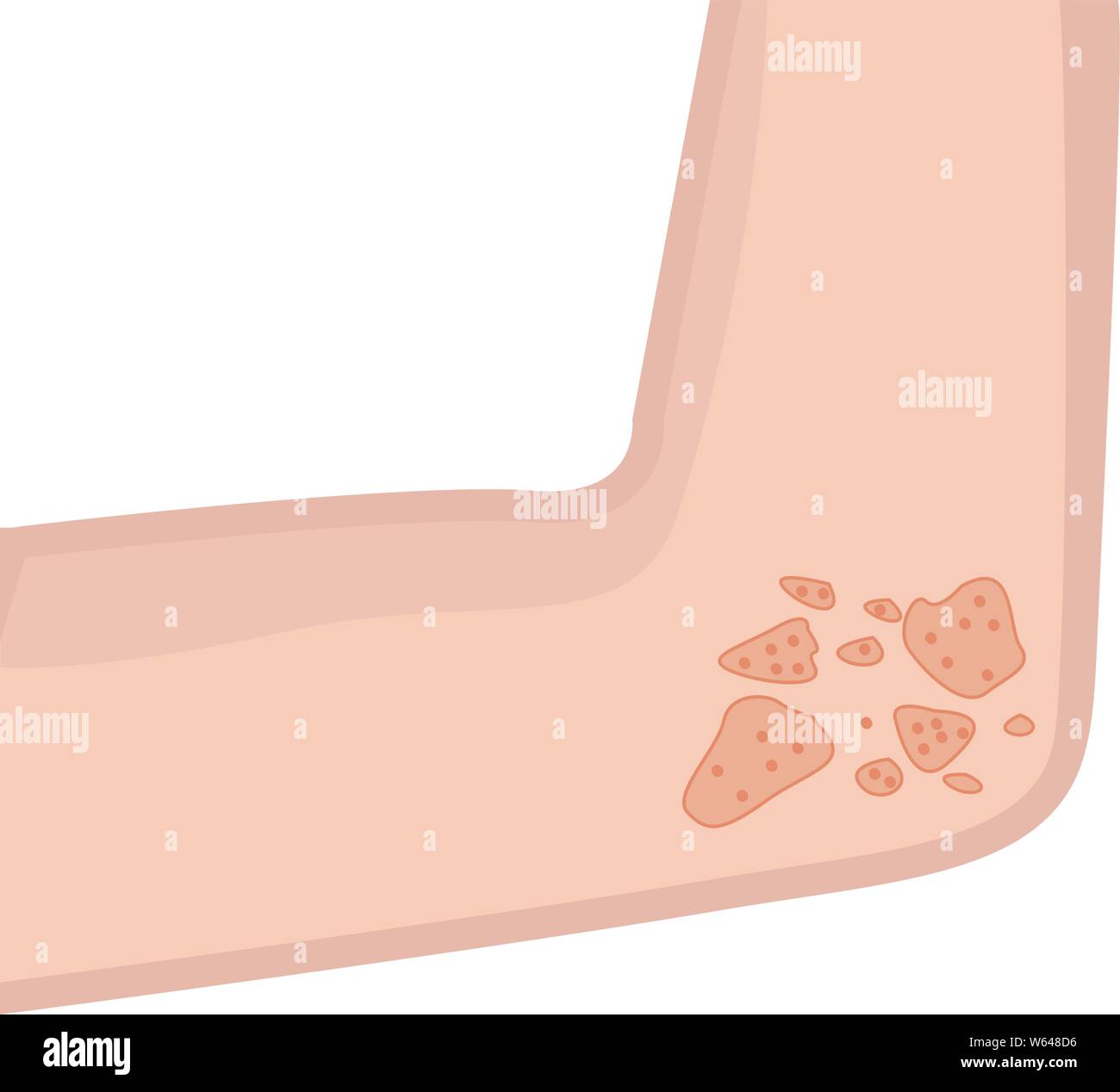 Person's elbow affected with eczema skin disease vector illustration ...
