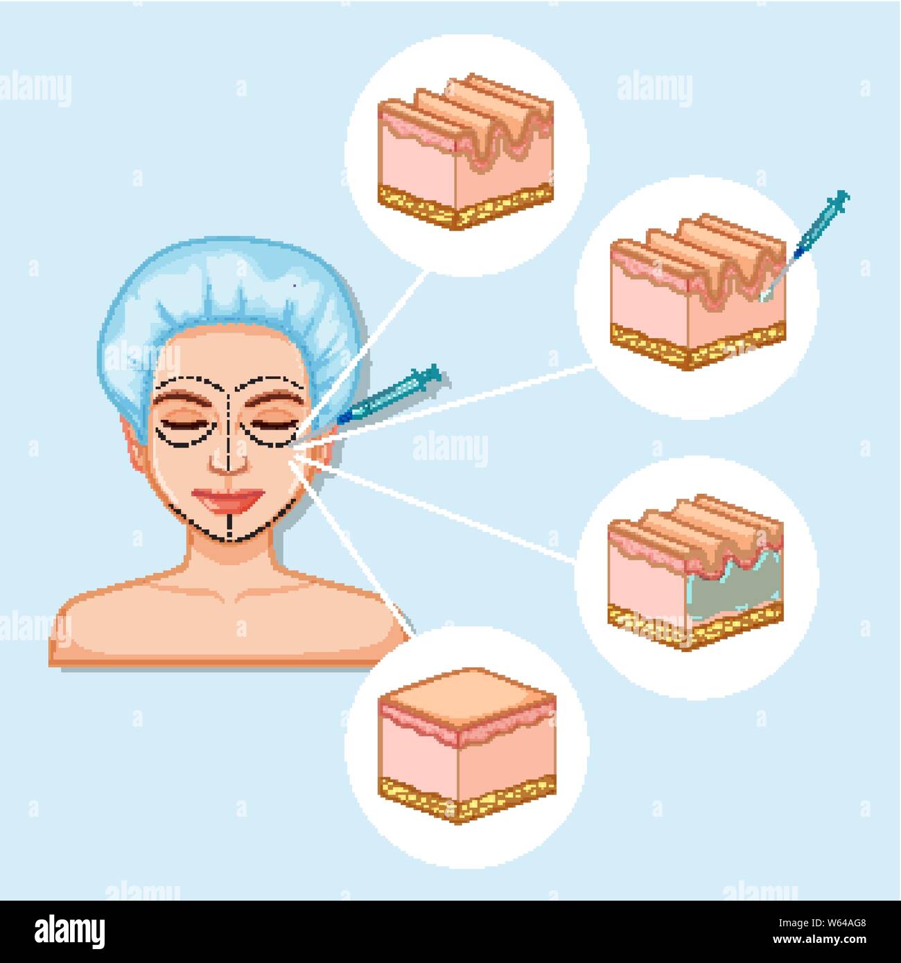 Scientific medical illustration of botox injection illustration Stock ...