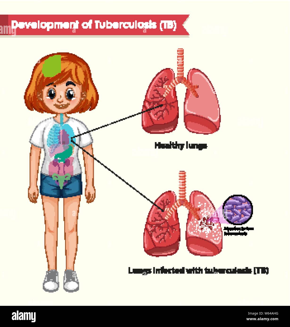 Scientific medical illustration of tuberculosis illustration Stock ...
