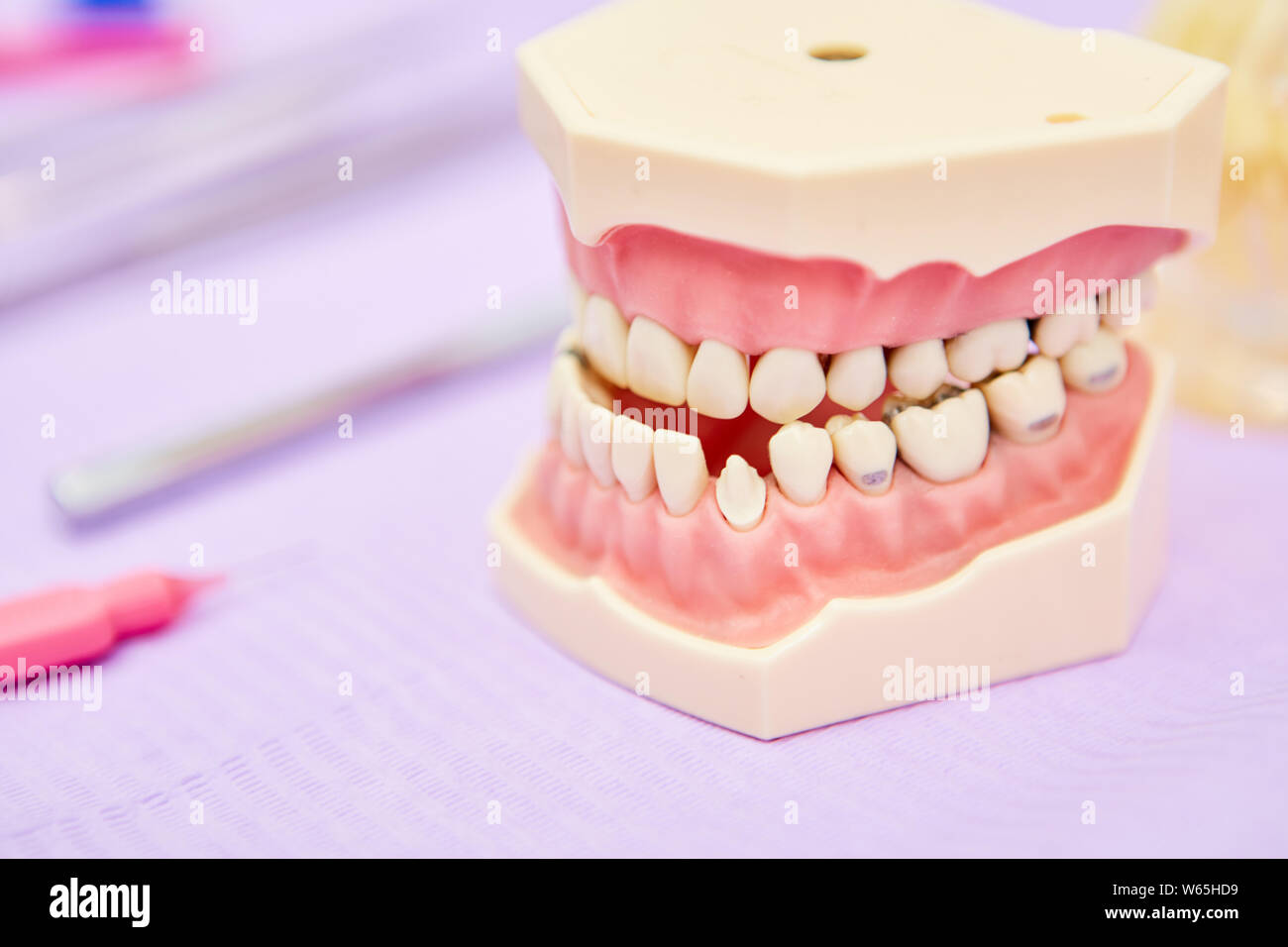 Malocclusion on a denture Model in a dental clinic as an example in ...