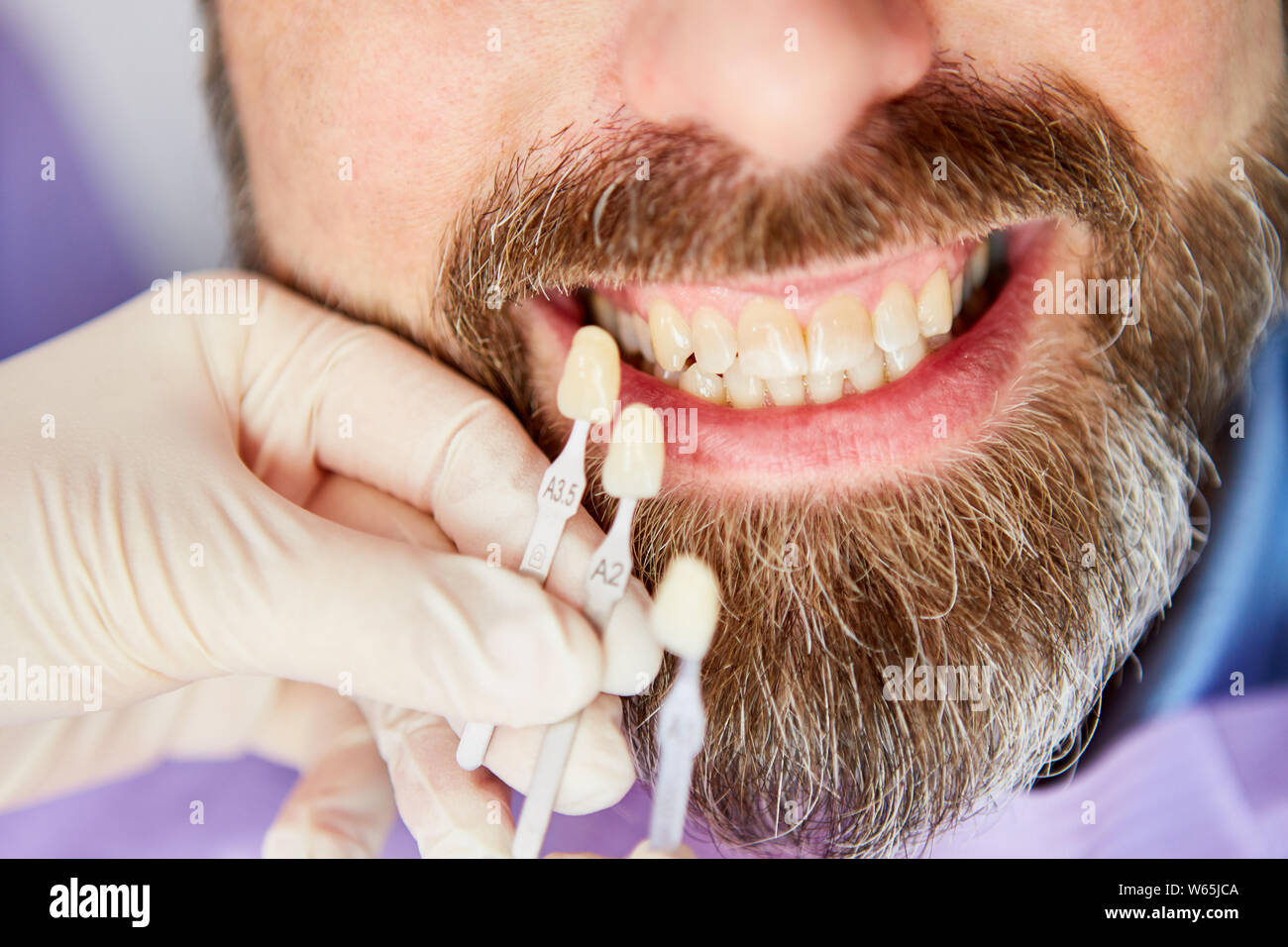 Adjustment of the tooth color of the patient during professional ...