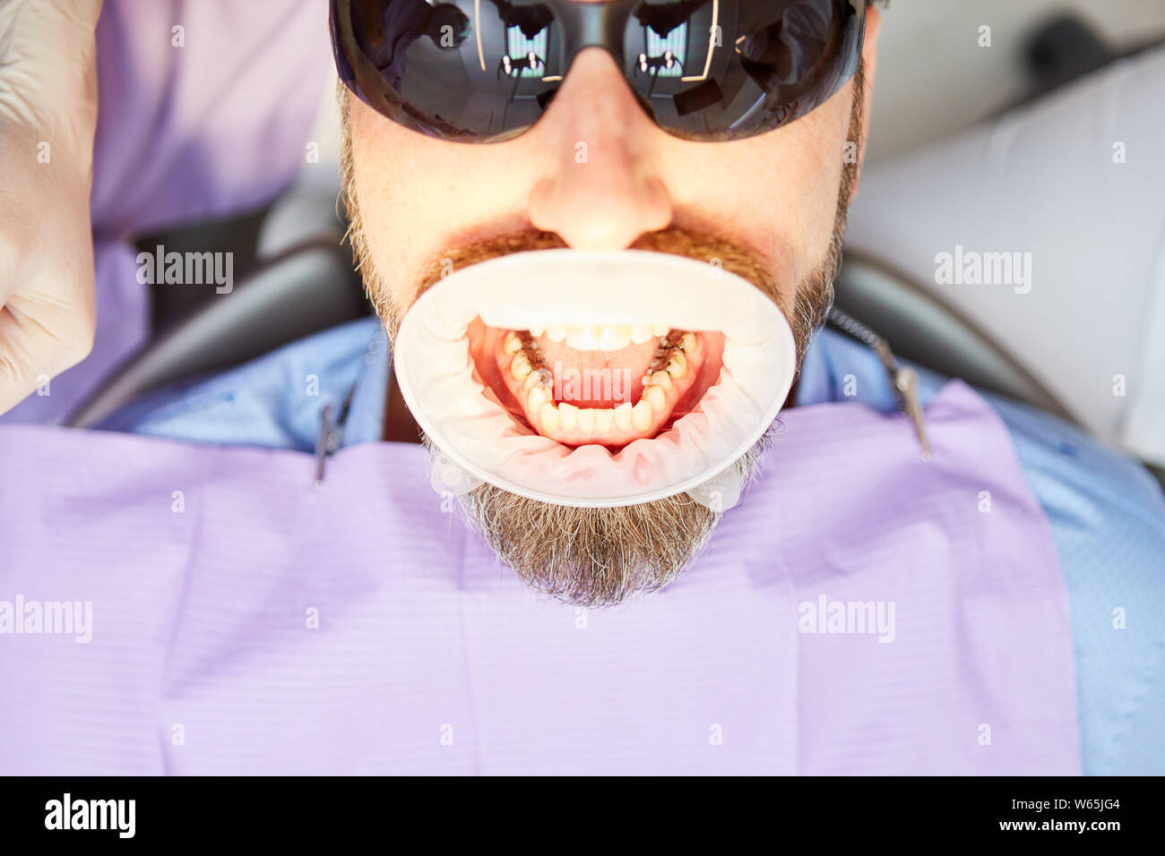 Patient with wide-open mouth in the chair at the dentist before ...