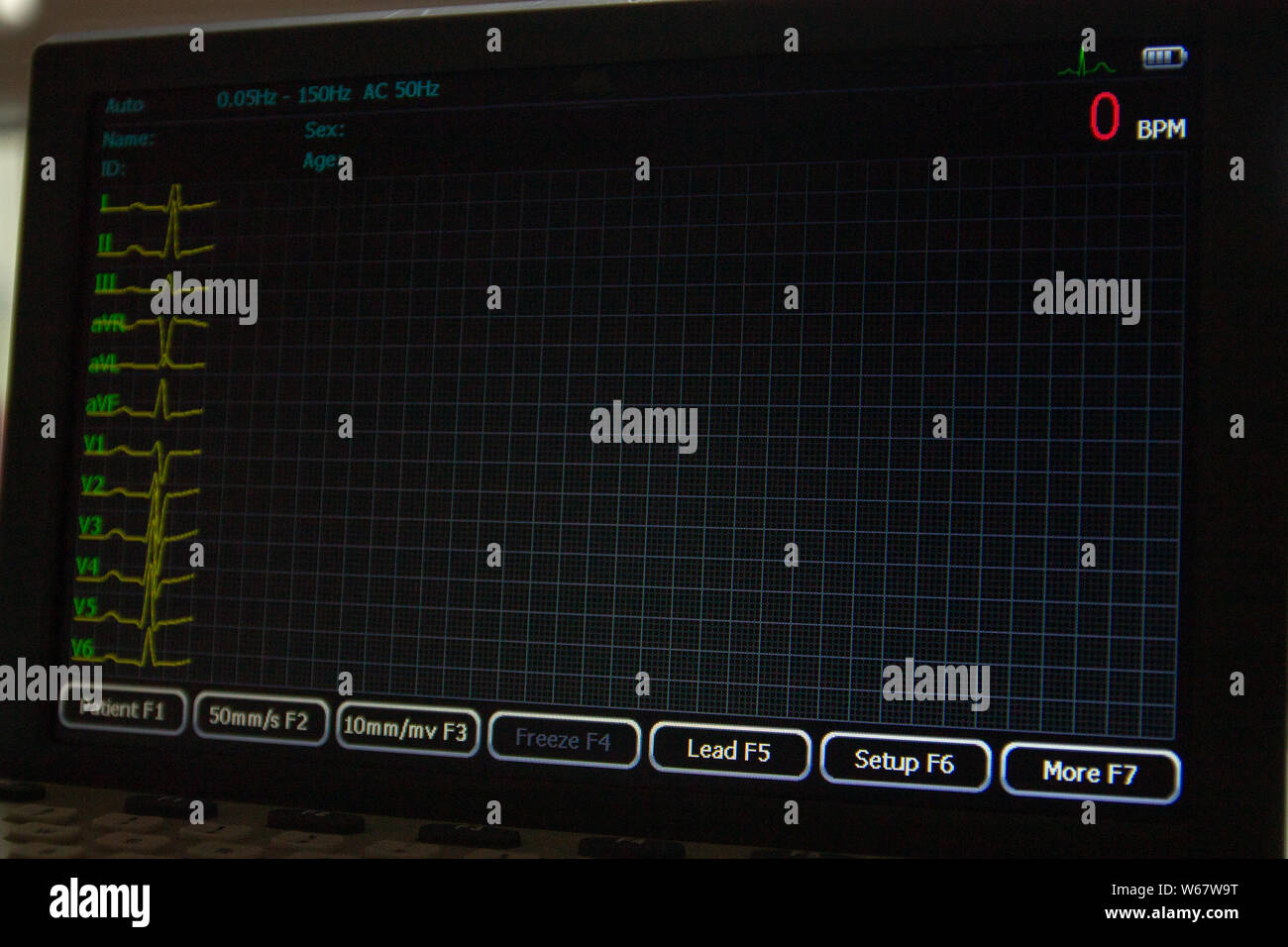 Screen of electrocardiograph device showing twelve yellow ECG ...