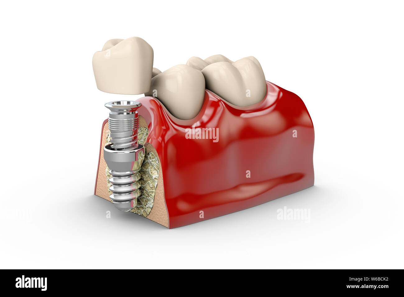 Human tooth model steel Cut Out Stock Images & Pictures - Alamy