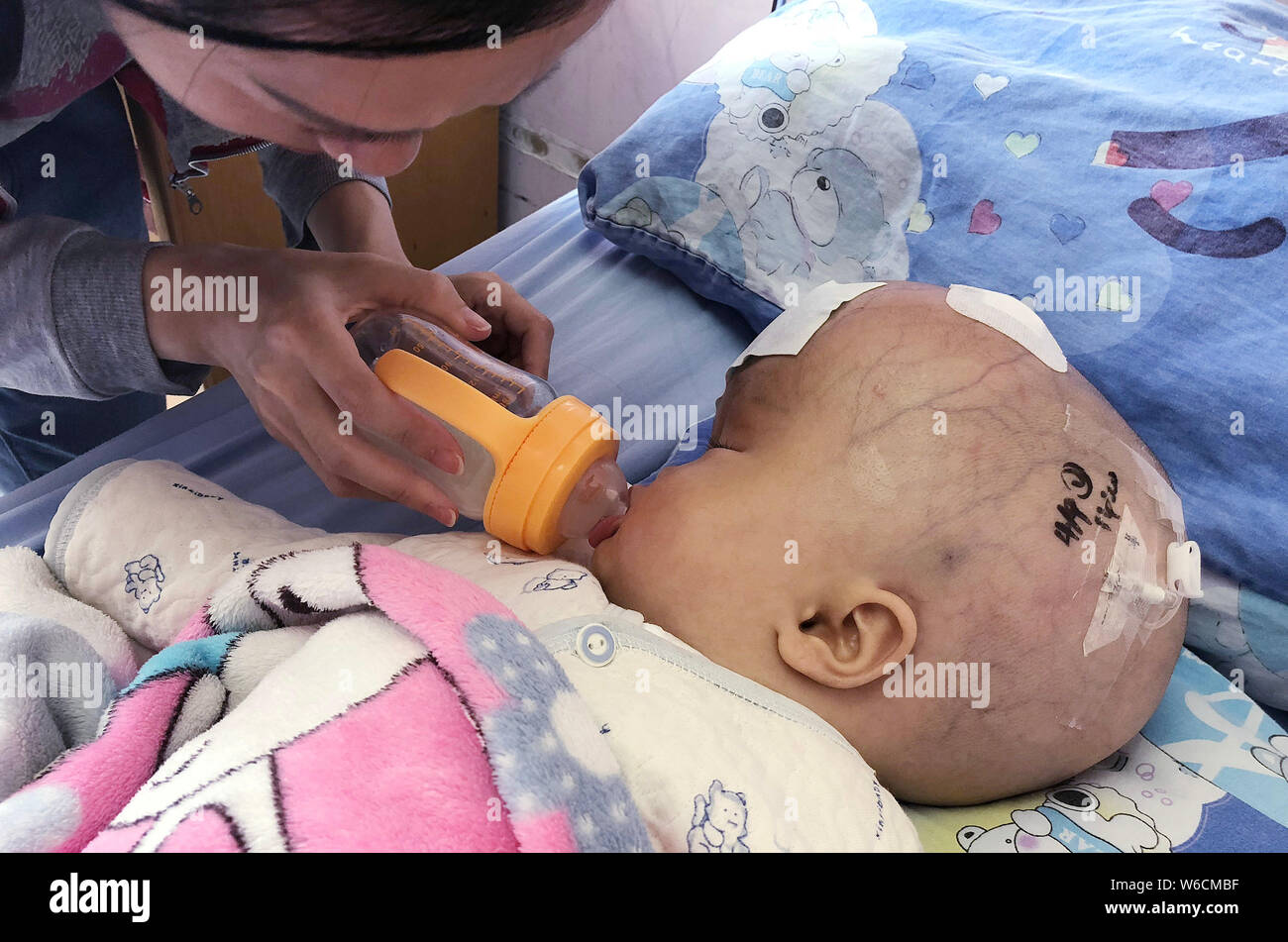 Severe Hydrocephalus In Fetus