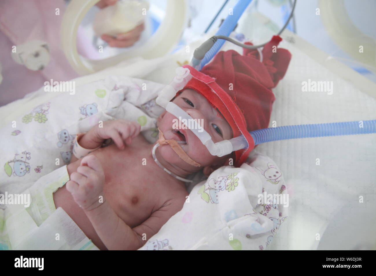 Child congenital hypothyroidism hi-res stock photography and images - Alamy