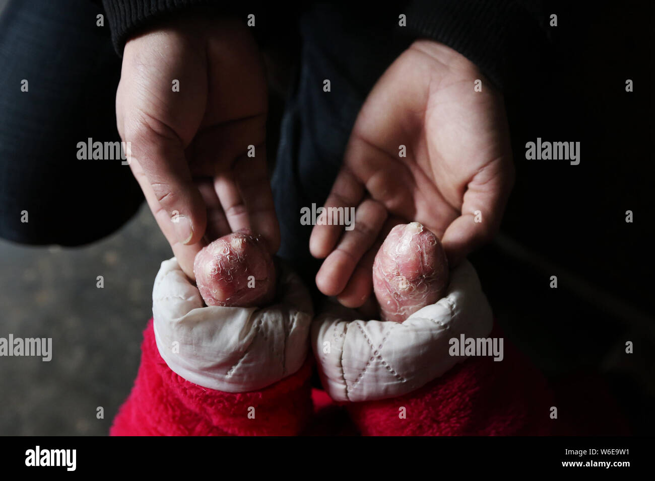 Epidermolysis bullosa hi-res stock photography and images - Alamy