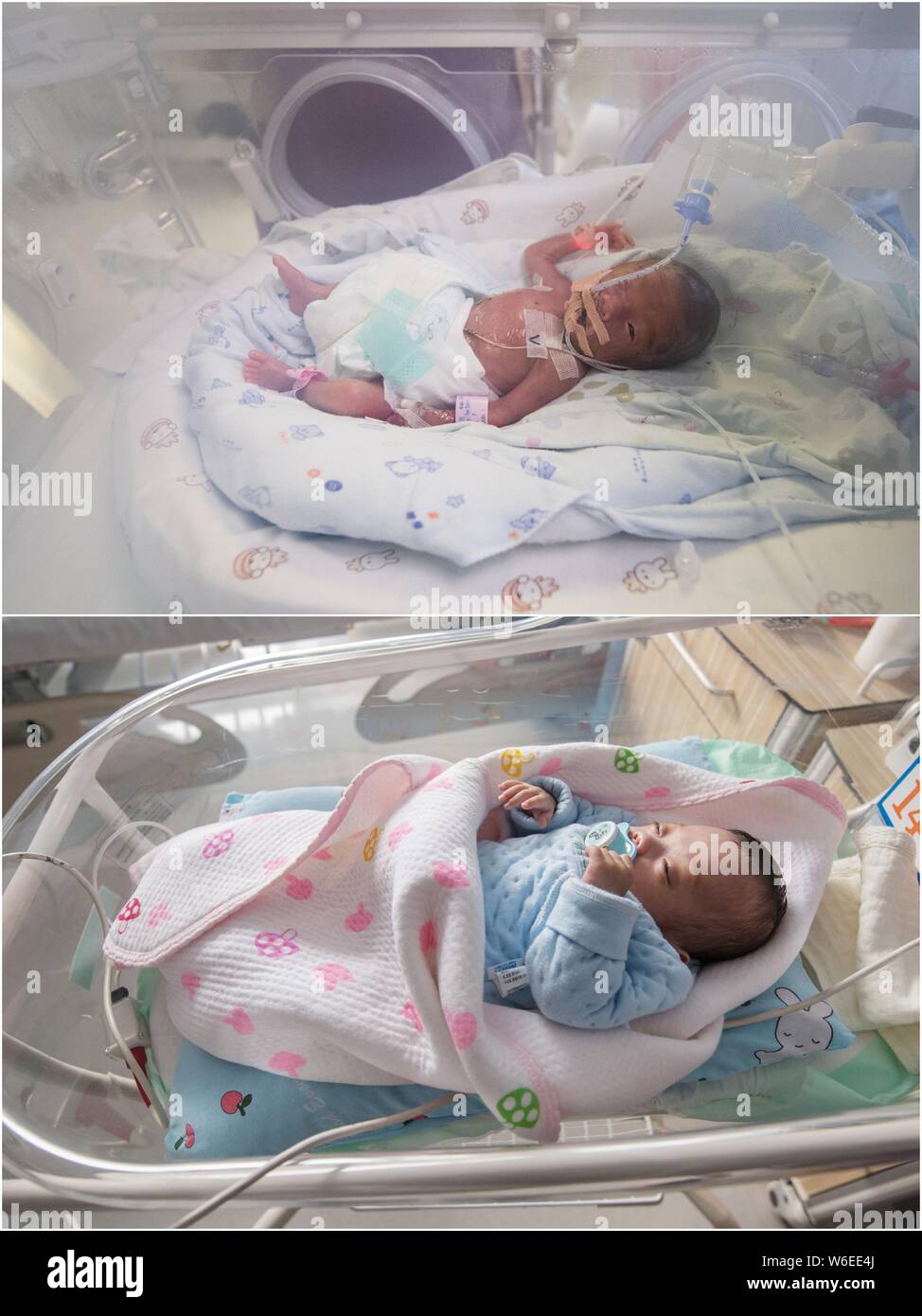 24 Week Old Premature Baby