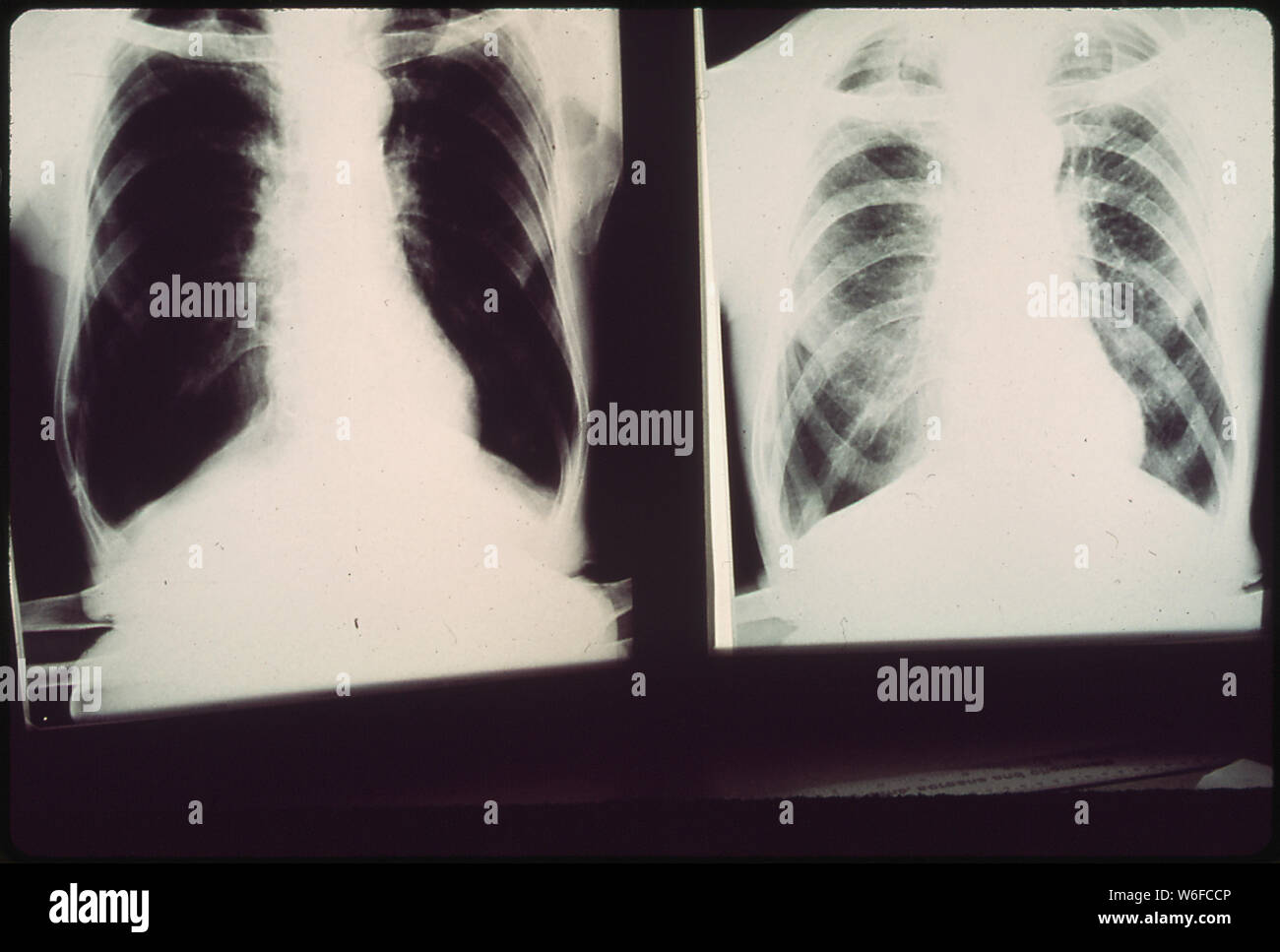 Black lung rays from hi-res stock photography and images - Alamy