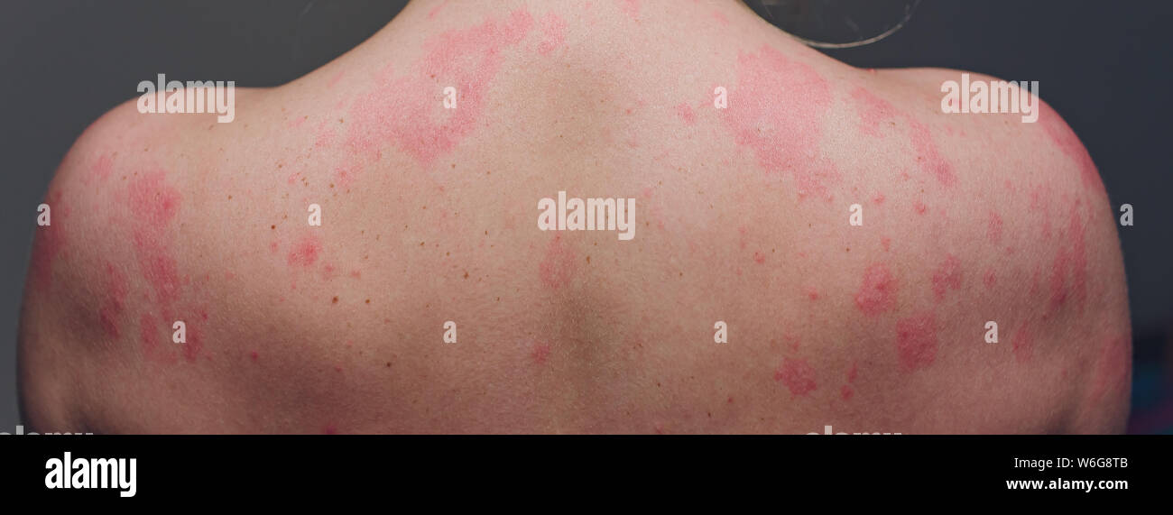 Close up Allergy rash, Around Back view of human with dermatitis ...
