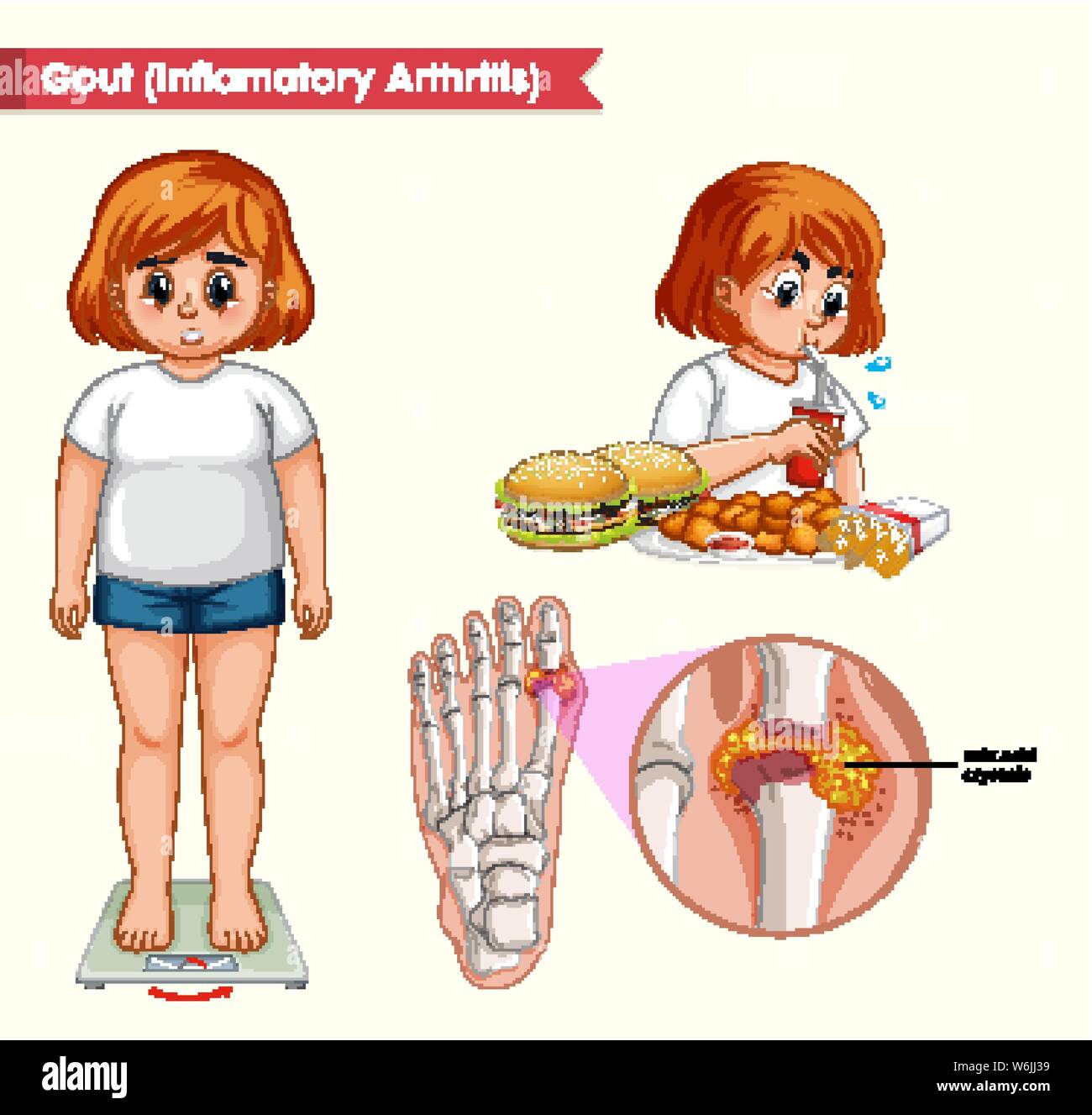 Scientific medical illustration of gout concept illustration Stock ...