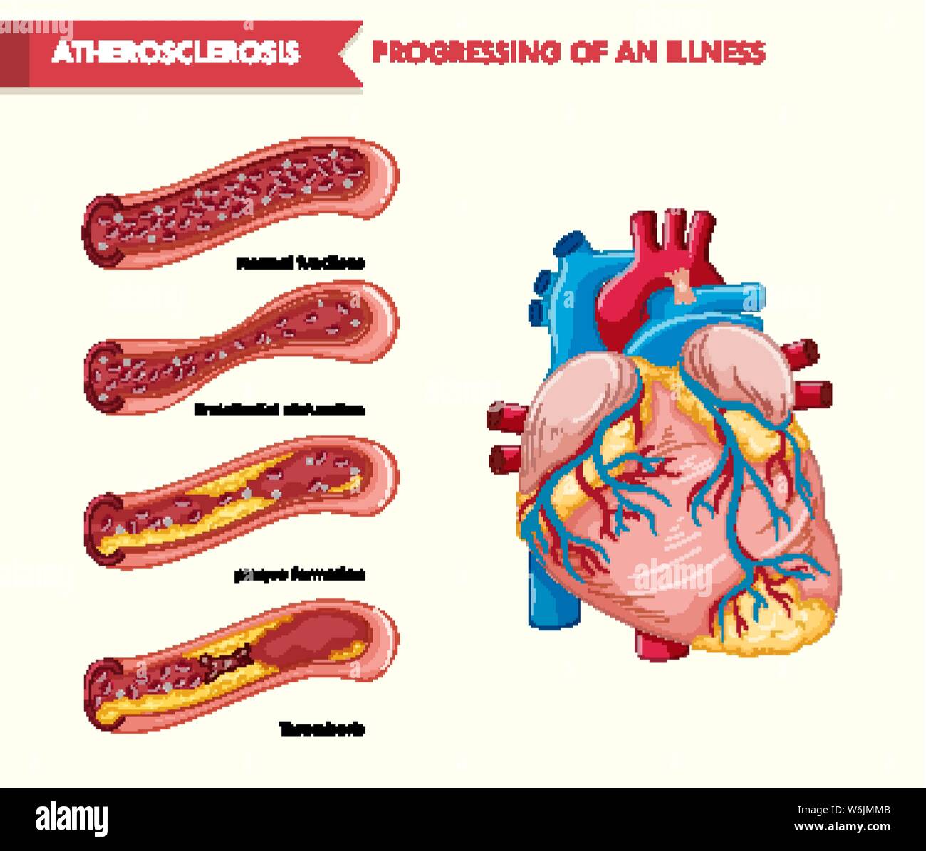 Scientific medical illustration of atherosclerosis illustration Stock ...