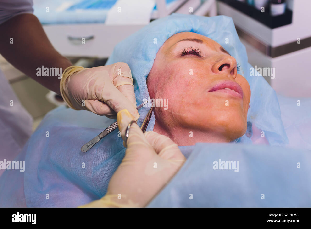 Meso thread lifting hi-res stock photography and images - Alamy