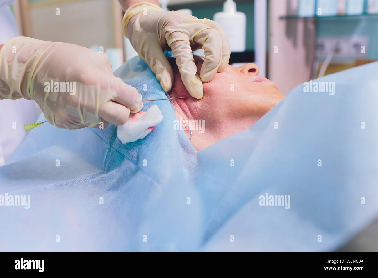 Threadlift High Resolution Stock Photography and Images - Alamy