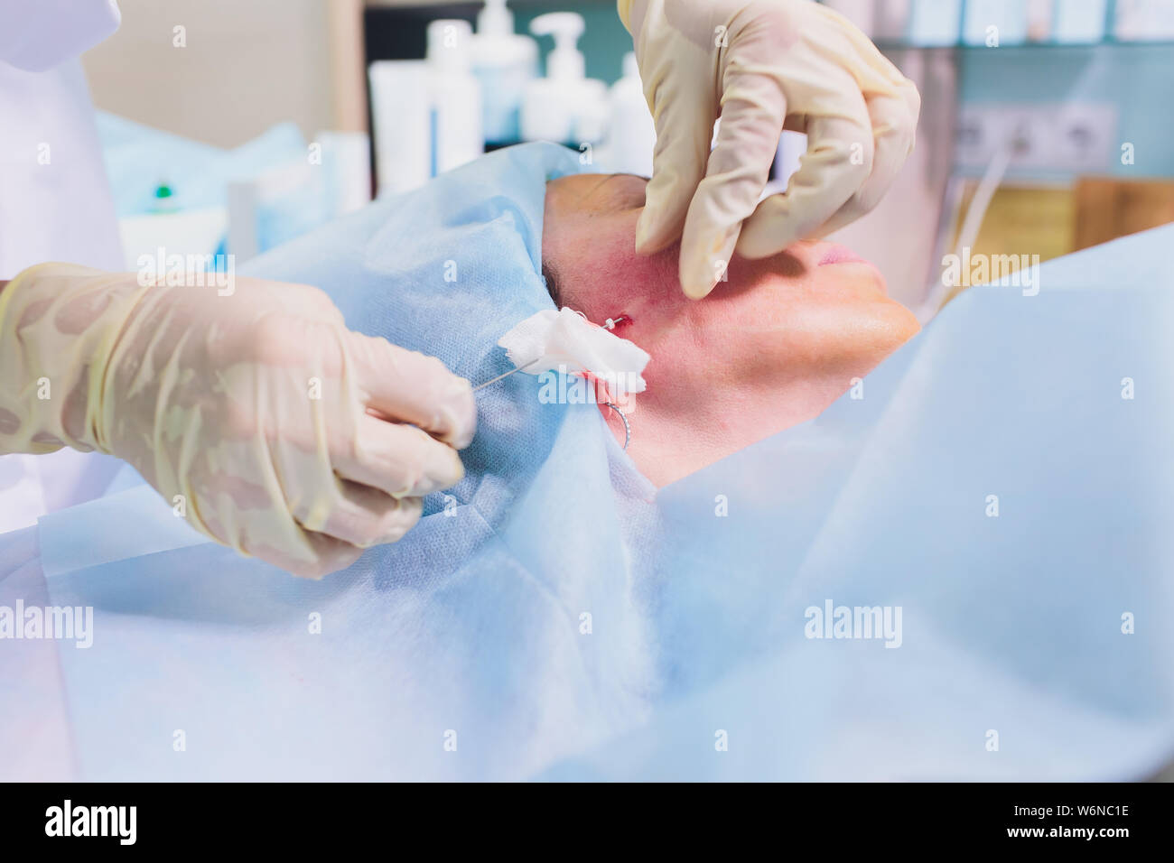 Aged woman doing mesothreads and Thread Lifting, Cosmetology. Cosmetic ...