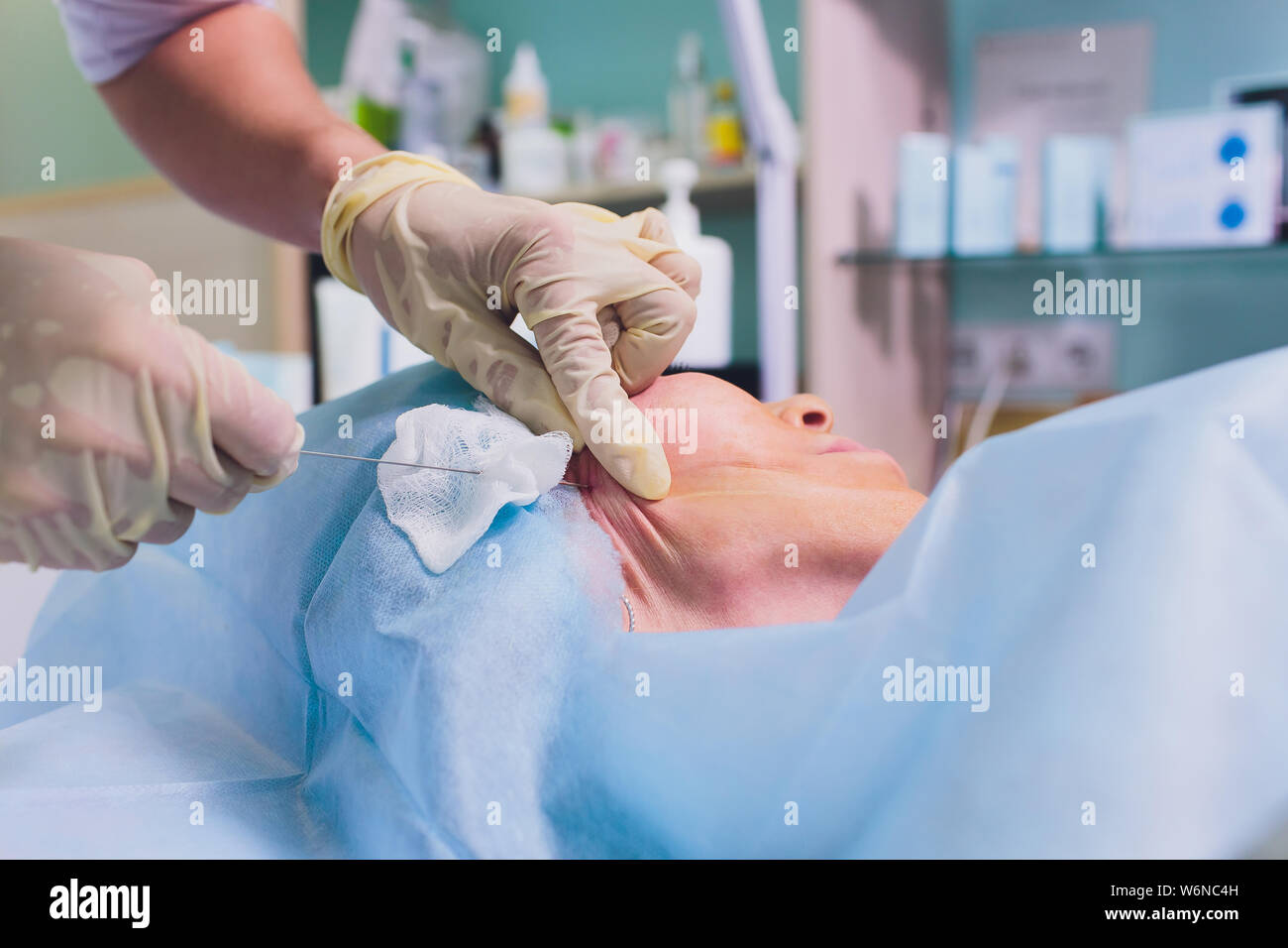 Threadlift High Resolution Stock Photography and Images - Alamy