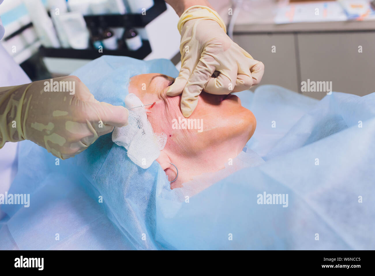 Aged woman doing mesothreads and Thread Lifting, Cosmetology. Cosmetic ...